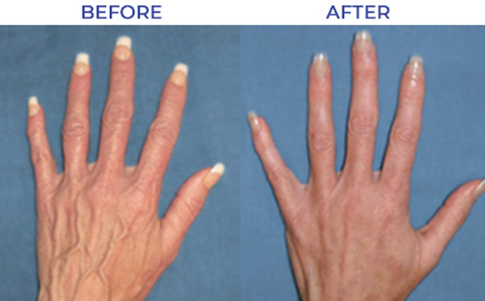 Vein Treatment Before & After Photos - Vein911®