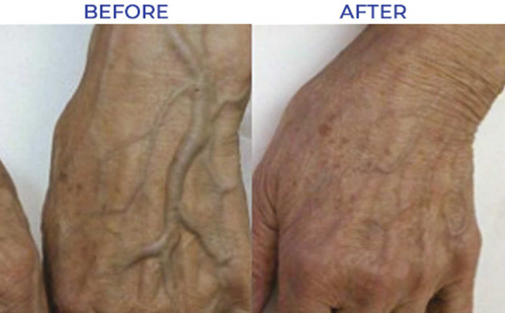 Vein Treatment Before & After Photos - Vein911®