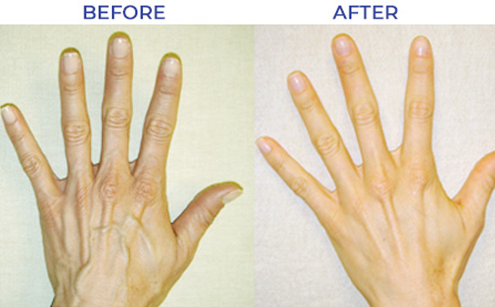 Vein Treatment Before & After Photos - Vein911®