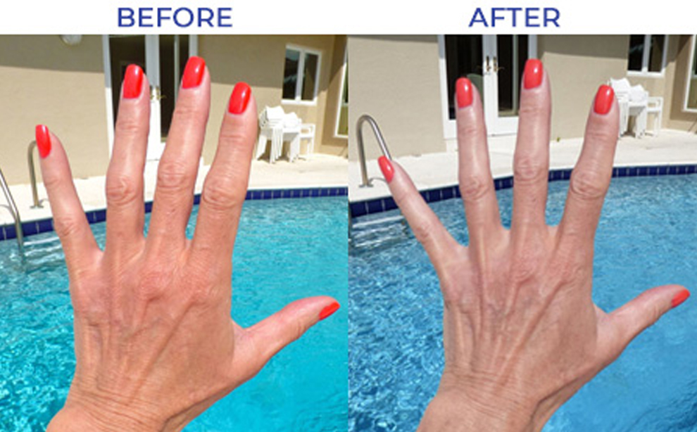 Vein Treatment Before & After Photos - Vein911®