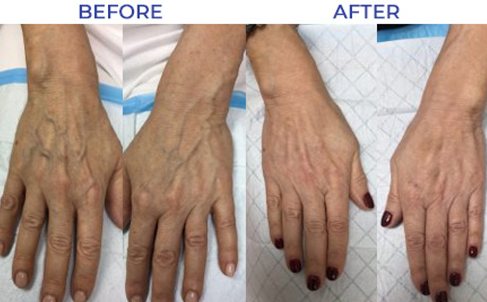 Vein Treatment Before & After Photos - Vein911®