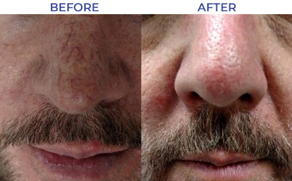 Vein Treatment Before & After Photos - Vein911®