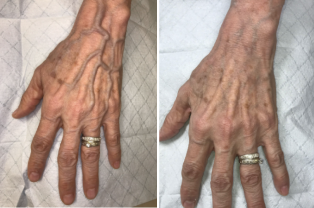 Bulging Hand Vein Treatment Tampa FL - Hand Vein Sclerotherapy