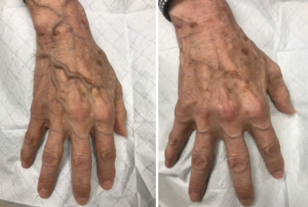 Bulging Hand Vein Treatment Tampa FL - Hand Vein Sclerotherapy