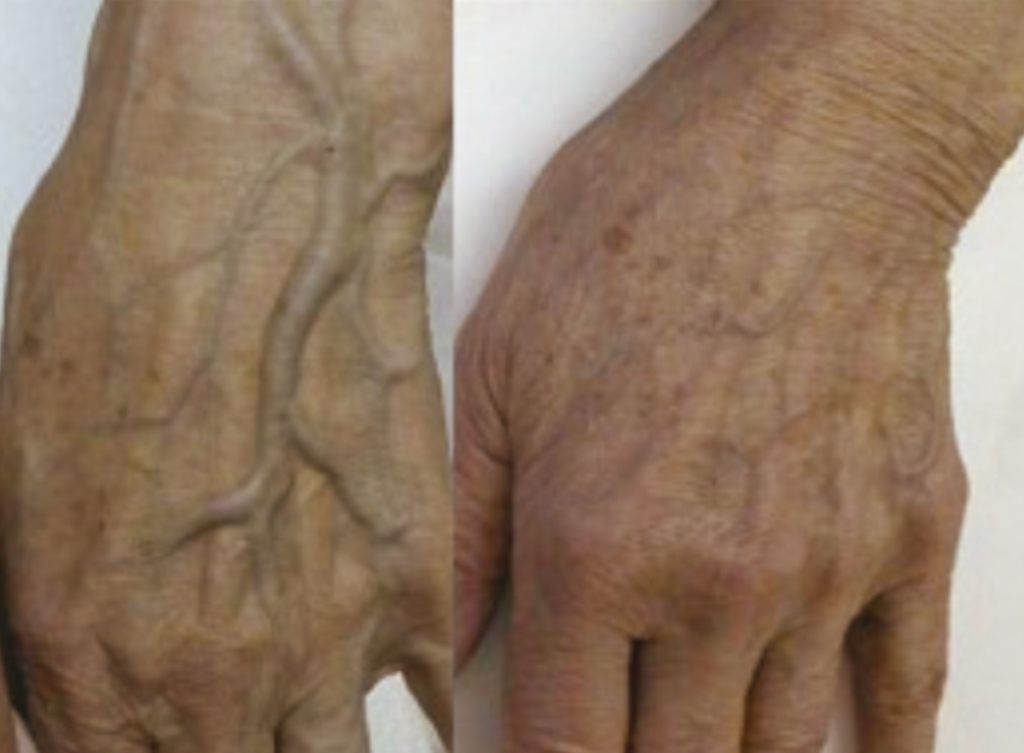 What Causes Veins to be More Visible in Hands? - Vein911® Vein ...