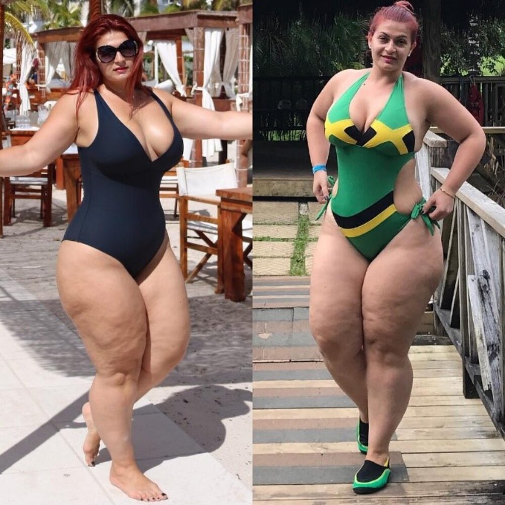 What is Lipedema? - Vein911® Vein Treatment Centers