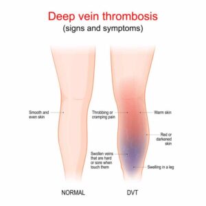 DVT Symptoms & Treatment in Tampa, FL