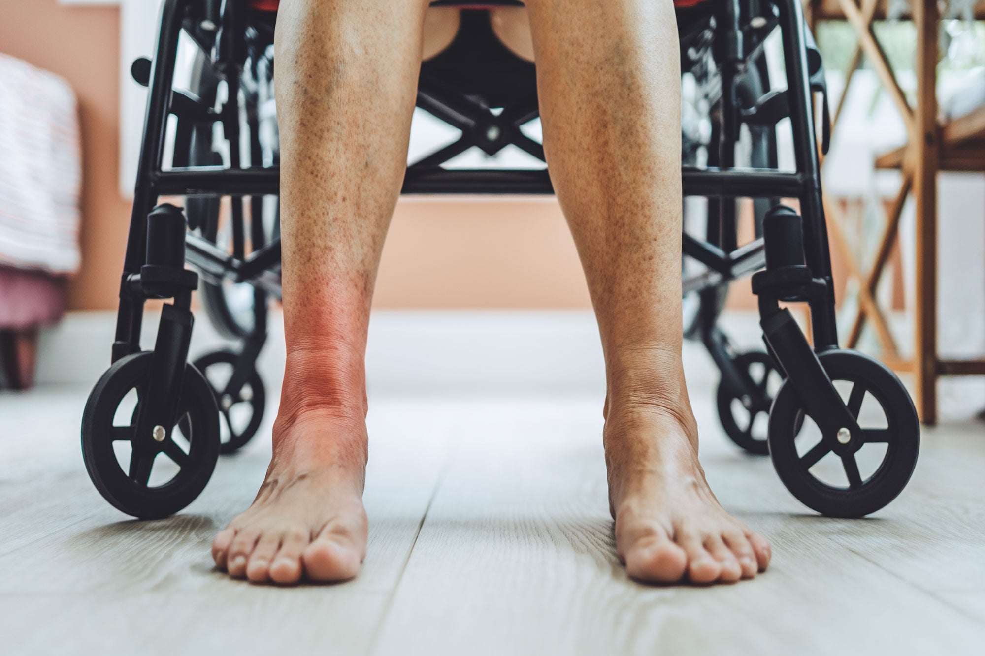 DVT Symptoms & Treatment in Tampa, FL