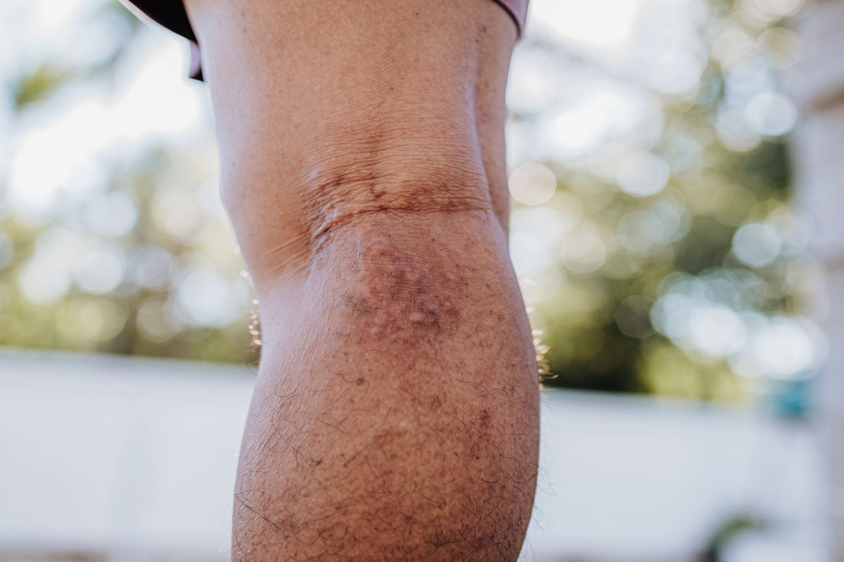 Skin Discoloration from Vein Disease Tampa