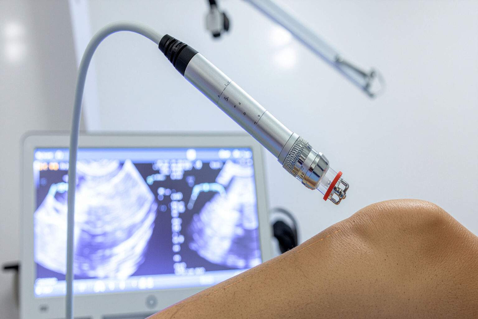 Thermal Ablation for Veins in Tampa