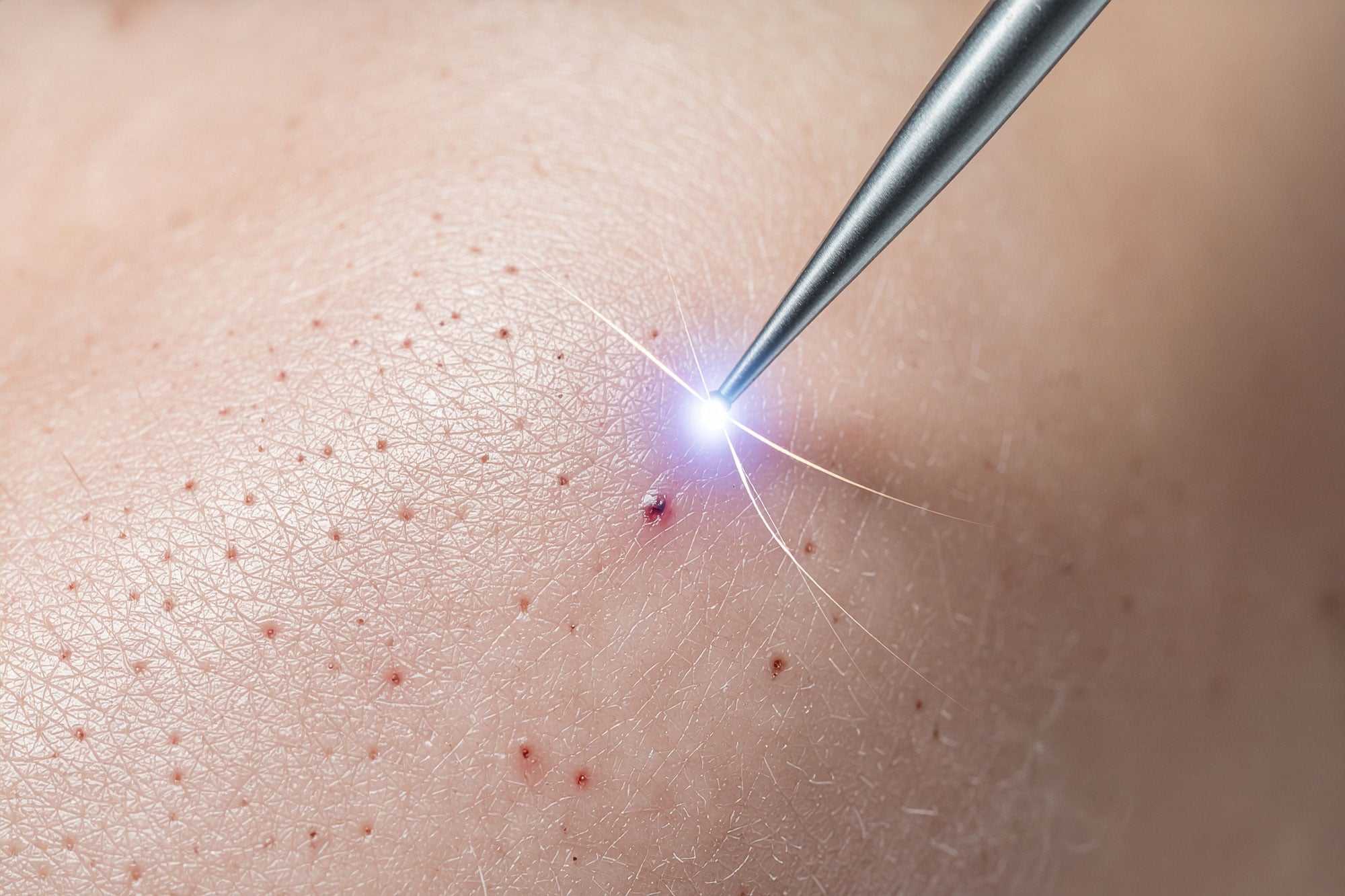 VeinGogh™ Spider Vein Treatment Tampa